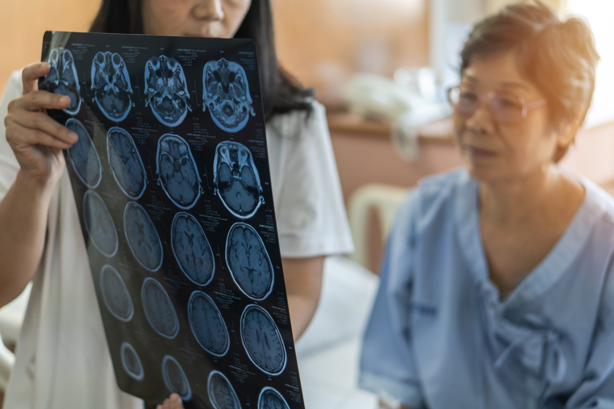 What to Expect Before and After Brain Surgery