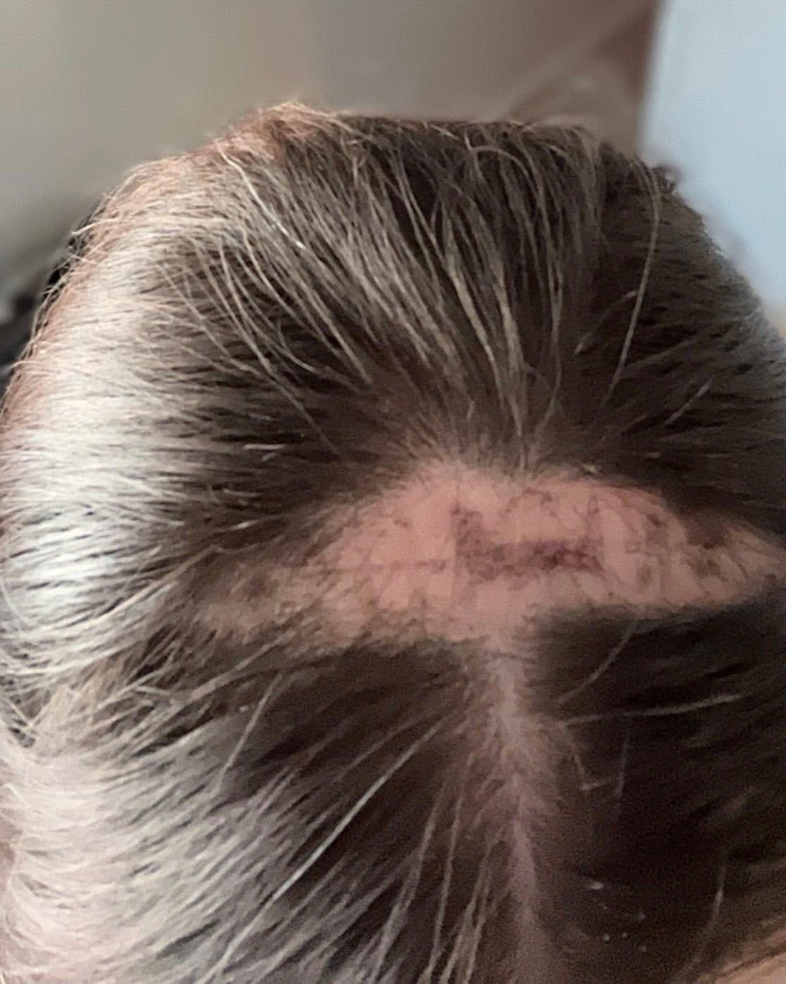 My Neuroscaretoma (Neurocytoma) Nightmare